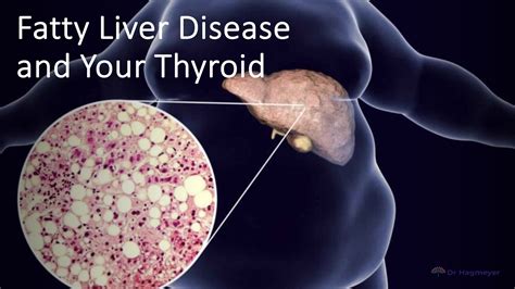 Fatty Liver Disease And Thyroid Disease Heres The Connection Dr Hagmeyer