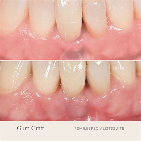 Periodontal Before And After Results Smile Gallery — Smile