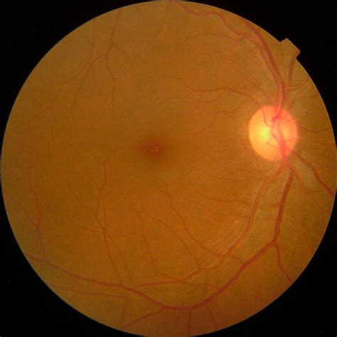 Opticdiscdetection Object Detection Dataset And Pre Trained Model By