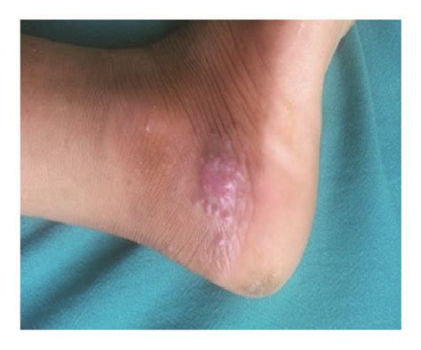 A Multiple Erythematous Papules Of Lupus Vulgaris Below Lateral