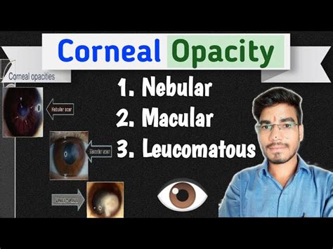 Corneal Opacity Types