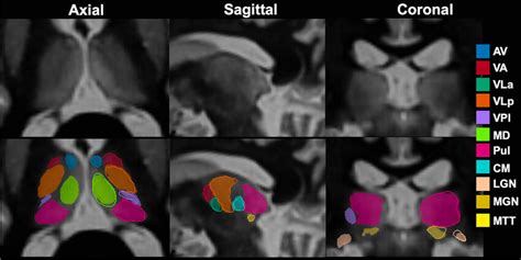thalamic nuclei predictions from the synthesized contrast segmentation