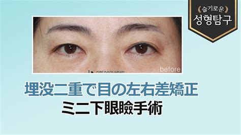 【韓国二重整形】中年女性の目の左右差、眉下切開と埋没二重整形で解消 Youtube
