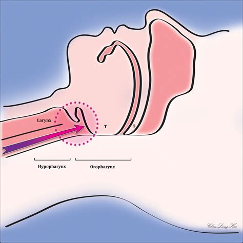 Acid Reflux Increases Susceptibility To Laryngopharyngeal And