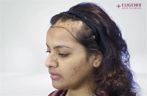 priya agrahari female hair transplant results and hair restoration