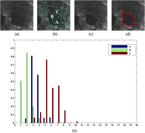 An Example Of A Tumor With Weak Boundaries A The Original Image B Download Scientific