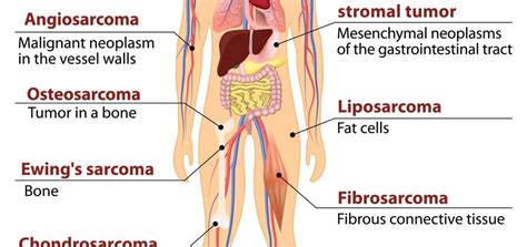 Primary Neoplasms Of The Musculoskeletal System Healthy Food Near Me