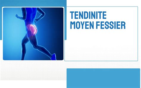 Prise En Charge Et Traitement De La Tendinite Du Moyen Fessier
