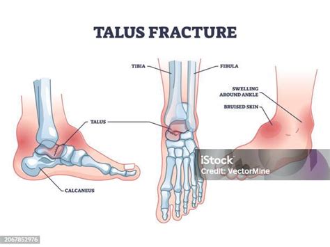 Talus Fracture And Broken Leg With Swelling Ankle Symptom Outline