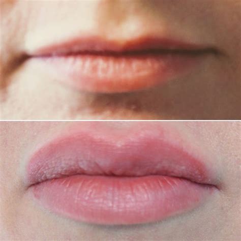 Juvederm Lips Balls At Tyson Macgillivray Blog