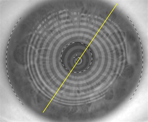 When The Cornea Is Not Routine Finding The Right Refraction In Patients With Keratoconus Eyeworld