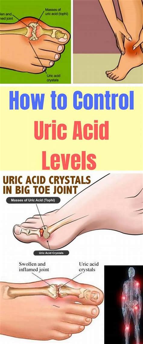 How To Control Uric Acid Levels Healthy Lifestyle