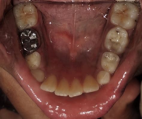 Obturation Of Primary Mandibular Second Molar Without Permanent