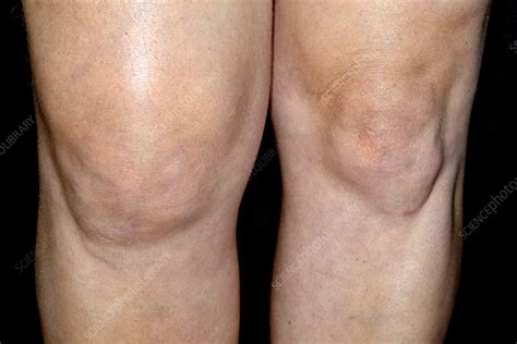 Swollen Knee Stock Image C0263365 Science Photo Library