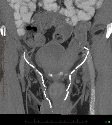 Ductus Deferens Calcification Pacs