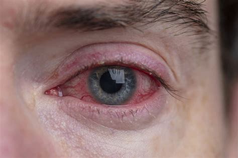 Chlamydia This Is The Unusual Symptom That Shows Up On Your Face
