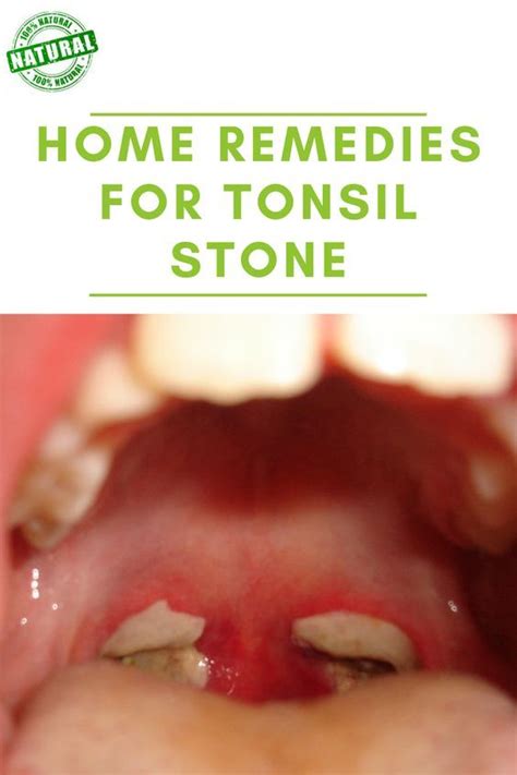 Bodyweight Back Workout Tonsilitis Remedy Tonsil Stone Removal Honey