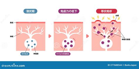 Shingles Infographics About Symptoms Of Herpes Zoster Cartoon Vector 259907203
