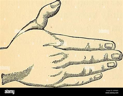 Metacarpal Dislocation Hi Res Stock Photography And Images Alamy