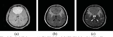 Figure 1 From Brain Tumor Type Detection Using Texture Features In Mr Images Semantic Scholar