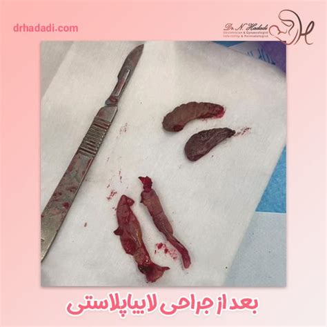 لابیاپلاستی با جدیدترین روش همراه با تصاویر واقعی دکتر نگین حدادی