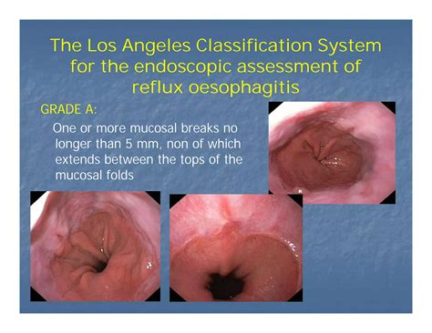 Gastroesophageal Reflux Disease Pdf