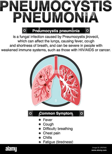 Informative Poster Of Pneumocystis Pneumonia Illustration Stock Vector
