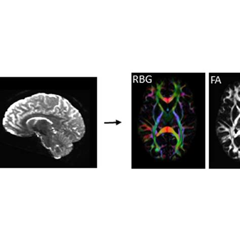 diffusion weighted imaging dwi data processing pipeline a anterior p