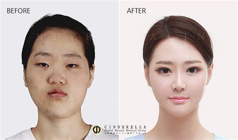 Cinderella Plastic Surgery Cinderella Plastic Surgery Before And After Photos Two Jaw Surgery