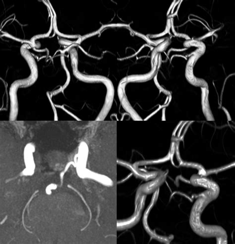Trigeminal Artery