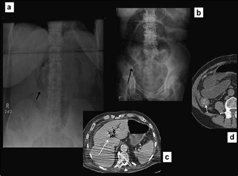 Gallstone Ileus A Plain Radiograph Showing The Central Distribution