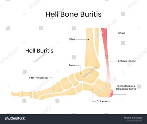 Symptoms Subcutaneous Calcaneal Bursitis Stock Vector Royalty Free