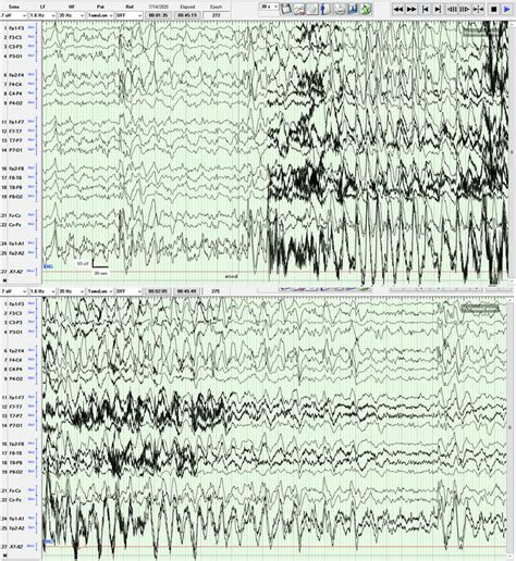 Two Consecutive Pages Of Eeg Excerpts Showing Hypnopompic Download