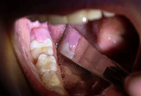 Tips After Wisdom Tooth Extraction