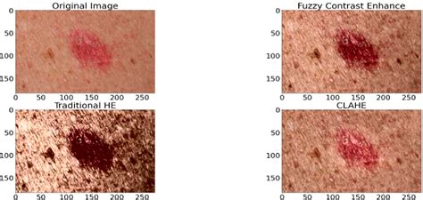 Figure 1 From Skin Lesion Analysis For Melanoma Detection Using The Novel Deep Learning Model