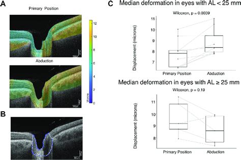 optic nerve head onh pulsatile displacement maps in different eye