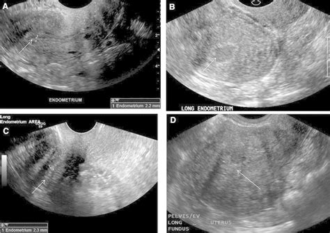 Pitfalls In Evaluating The Endometrium A Incorrect Measurement Of The