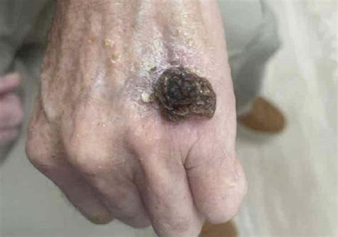 Practical Dermatology On Linkedin Squamouscell Basalcell