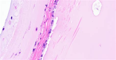 Neuropathology Blog Colloid Cyst Of The Third Ventricle