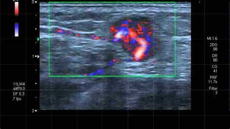 Video2 Thyroid Youtube