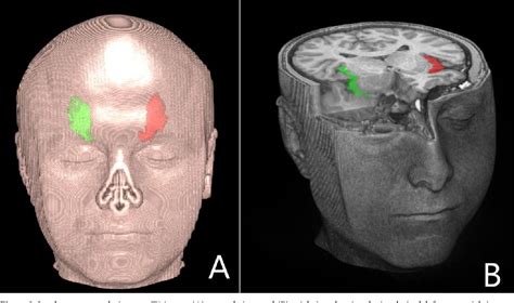 Figure 1 From The Role Of Lateralisation And Sex On Insular Cortex 3d