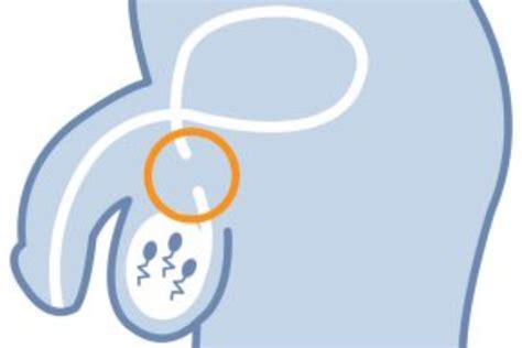 No Scalpel Vasectomy Dr Anand Arumugam