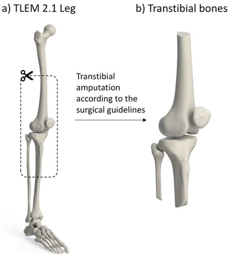 Applied Sciences Free Full Text Development Of A Generic Numerical Transtibial Model For