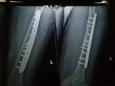 女子上私教课时腿被压骨折 健身房老板称未和教练签劳动合同不担责 律师：健身房应负责腾讯新闻