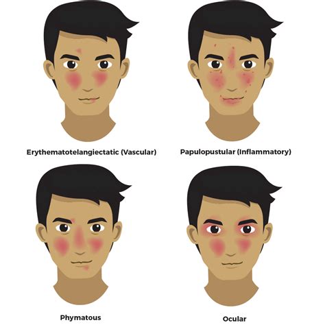 Rosacea Treatment In San Diego Ca