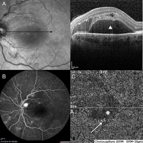 Pdf Unilateral Hypertensive Choroidopathy As A Sole Manifestation In