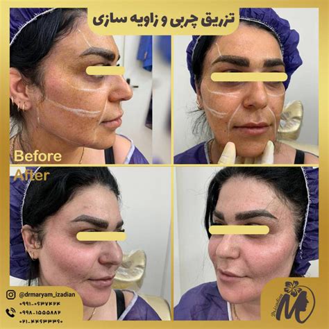 تزریق چربی و زاویه سازی دکتر مریم ایزدیان