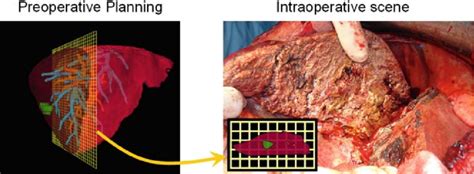 Basic Concept Design Of The Resection Map To Transfer The Preoperative Download Scientific
