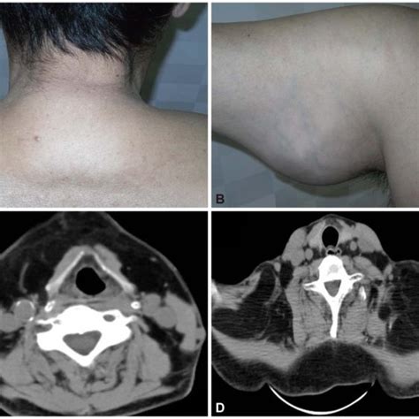 Multiple Lipomatosis Lesions And The Neck Computed Tomography Findings