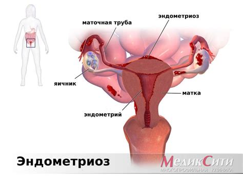 Менструальный цикл Как рассчитывать Лечение нарушений менструального